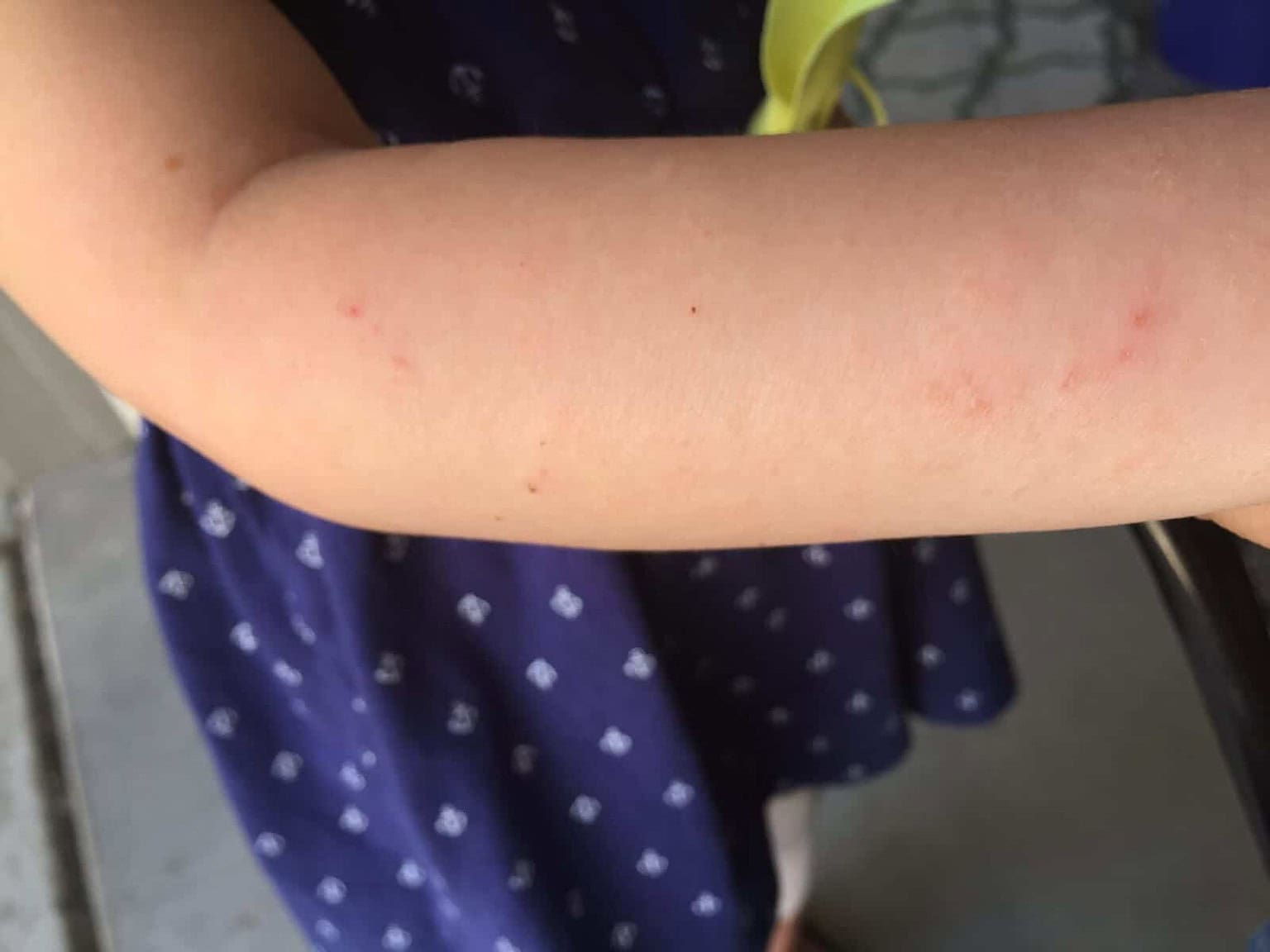 5 Tips For Treating Toddler Eczema